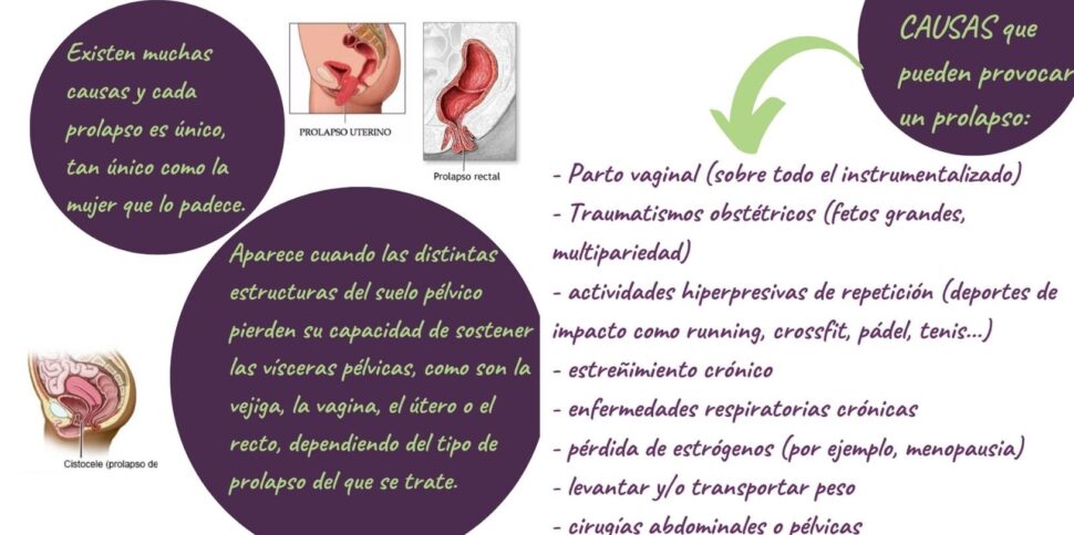 Prolapso - Impulsa Fisioterapia