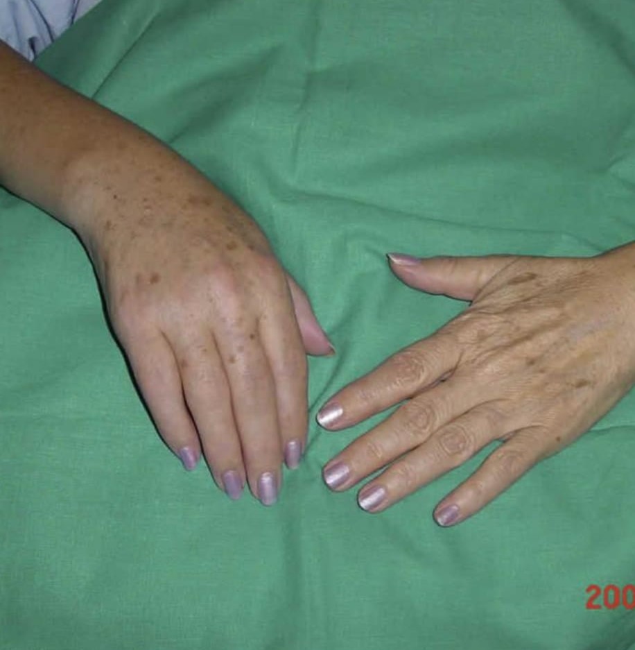 Síndrome de dolor regional complejo o Südeck - Impulsa Fisioterapia