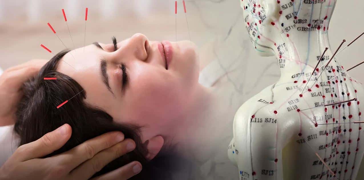 Acupuntura y sus beneficios - Impulsa Fisioterapia