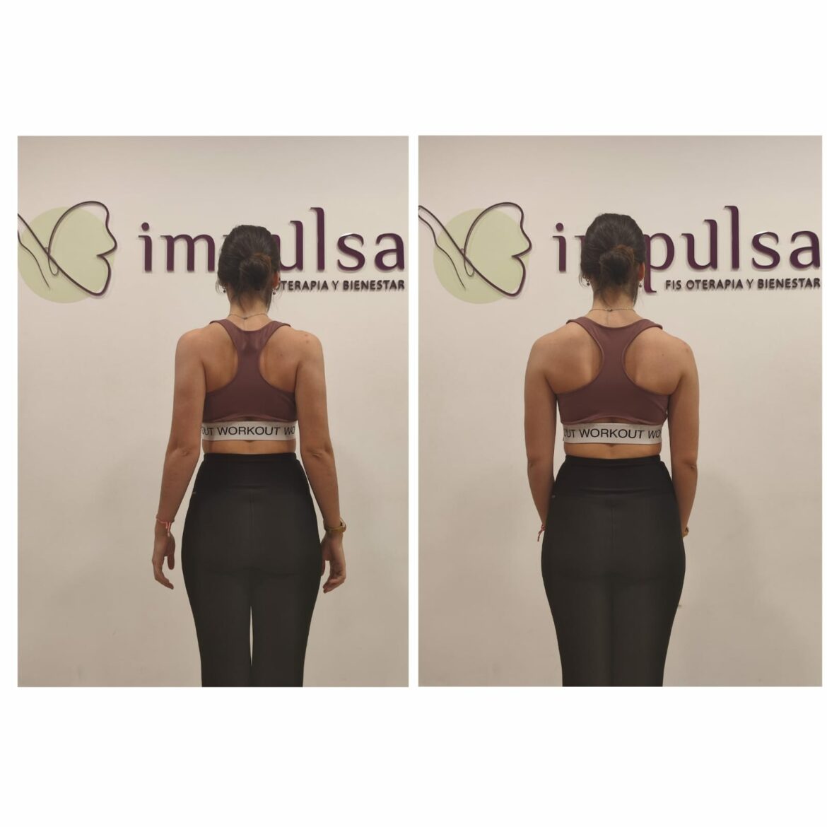 La Escápula y su Importancia en la Salud del Hombro - Impulsa Fisioterapia